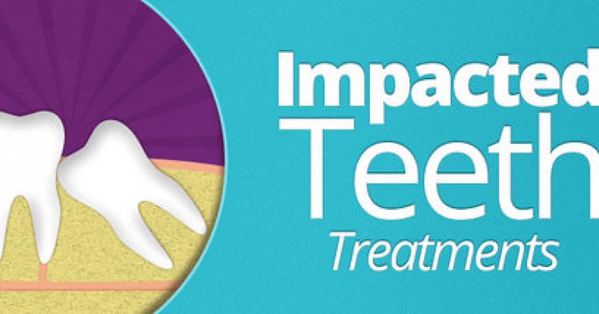 Impacted teeth - a tooth that gets blocked as it is erupting (coming ...