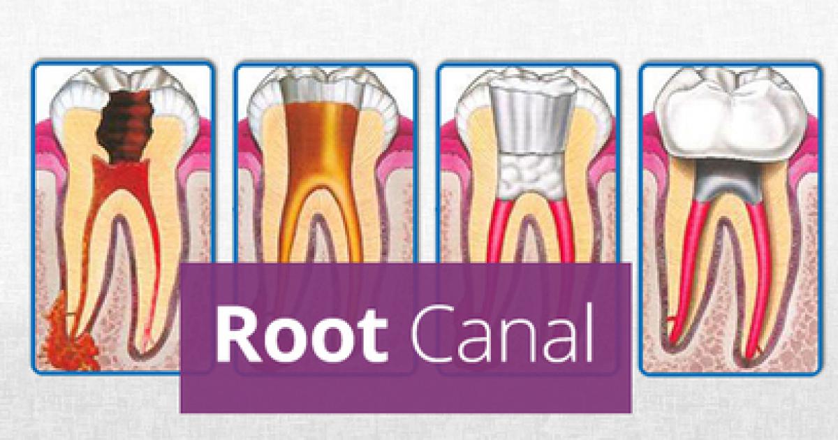 Root Canal, Los Algodones, Mexico Treatment, Dental Tourism, Sani ...