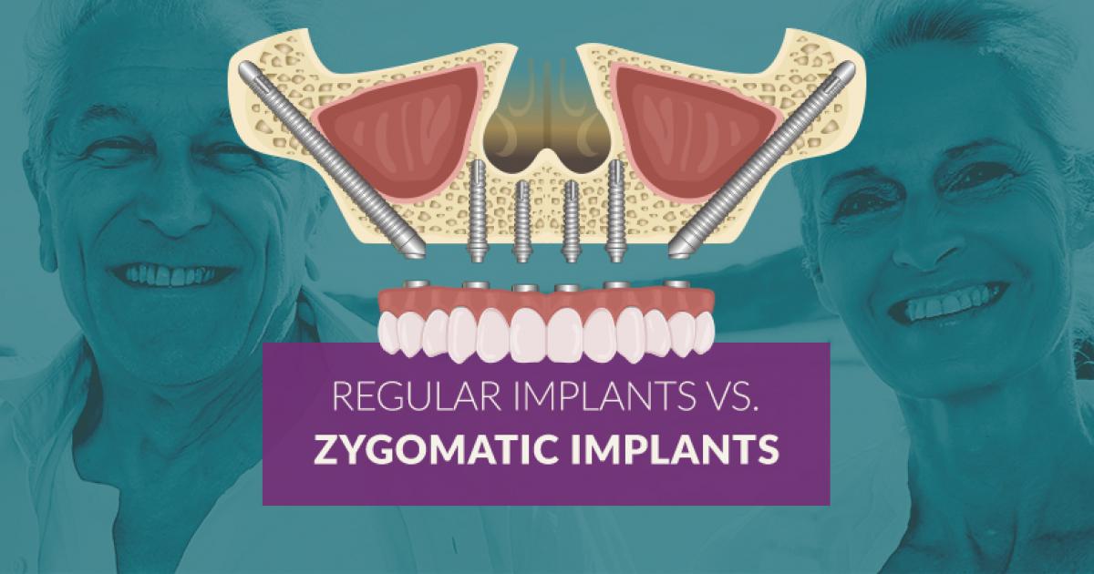 Main Differences between Regular and Zygomatic Implants