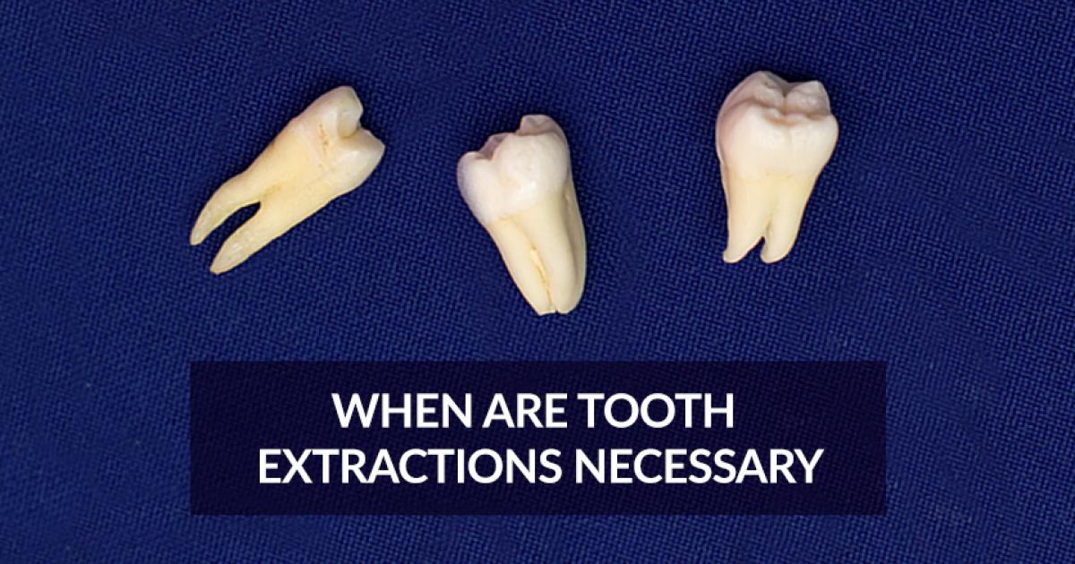 When Does A Tooth Need To Be Extracted?