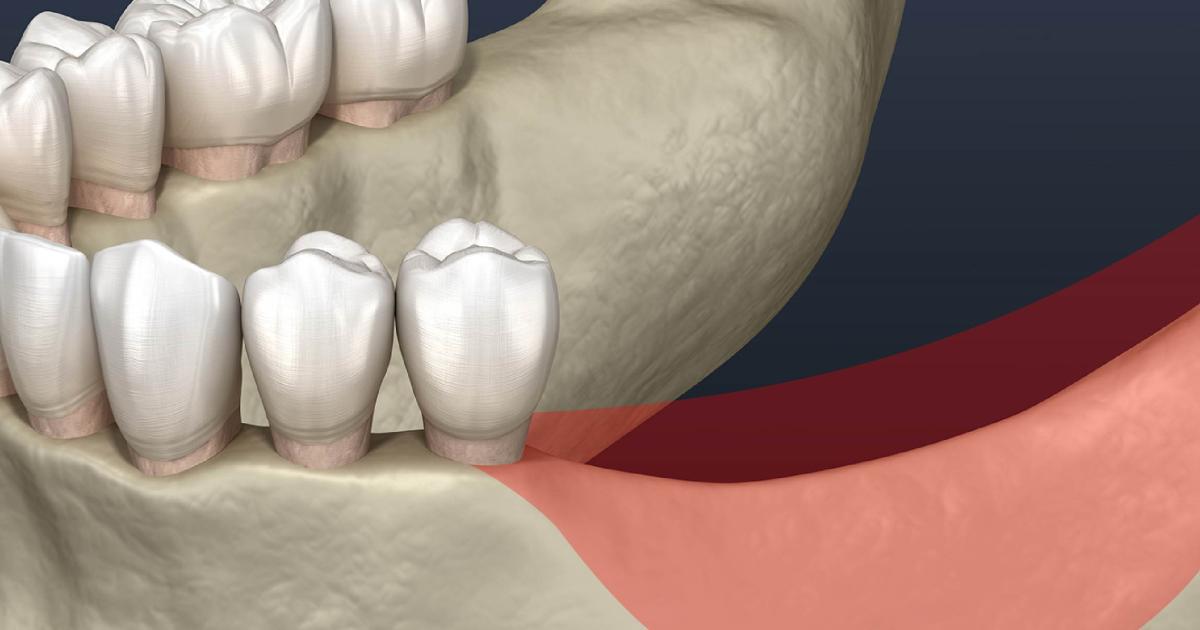 What Causes Bone Loss in Teeth? Common Reasons and Treatment Options ...