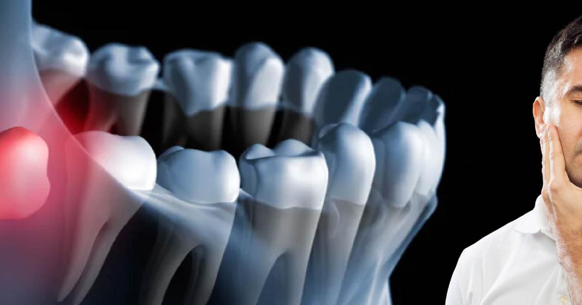 What Happens If You Don't Get Your Wisdom Teeth Out? | Risks & Consequences