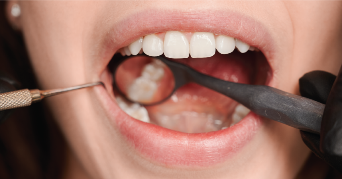 Cavity Between Teeth: Understanding, Treating, and Avoiding Issues