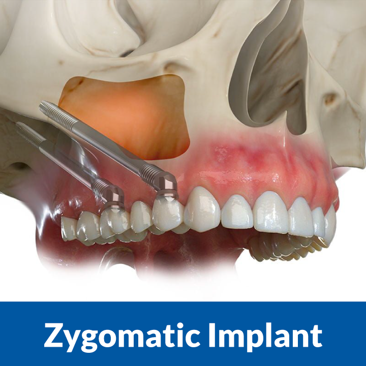 Advantages and Disadvantages of Zygomatic Implants