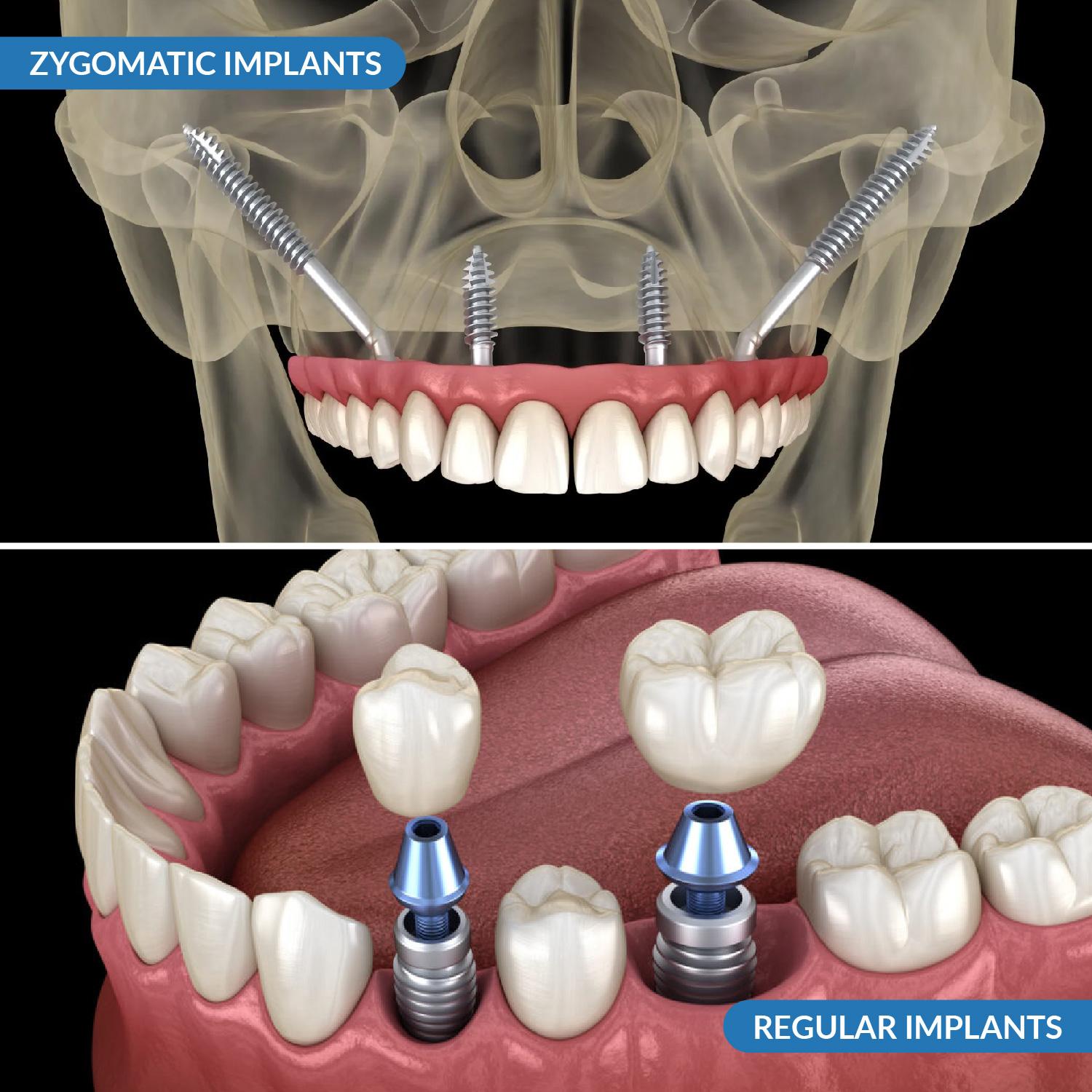 Advantages and Disadvantages of Zygomatic Implants