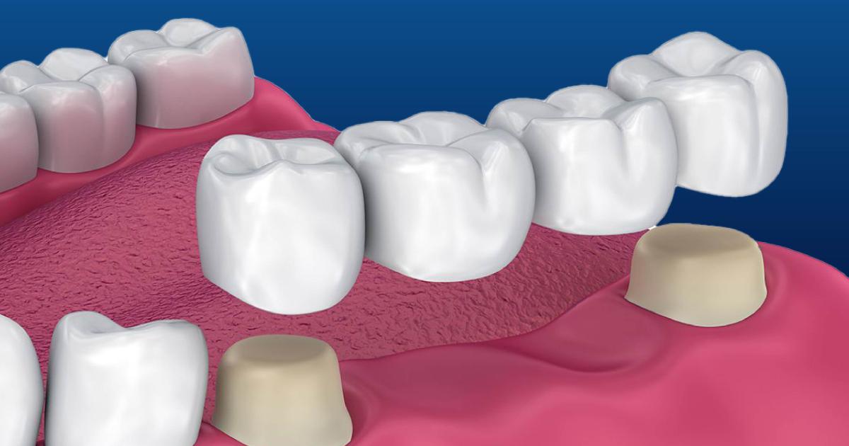 Tooth Bridge Cost: Affordable Dental Bridges | Sani Dental Group Best